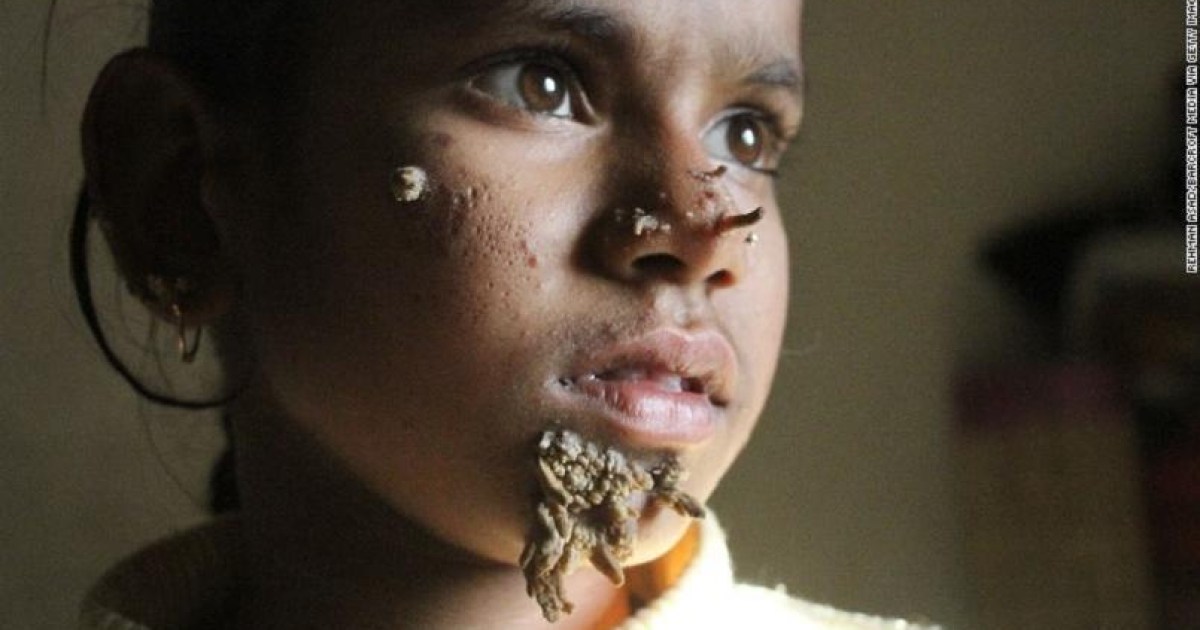 Young girl diagnosed with 'tree man' syndrome in Bangladesh - Loop News