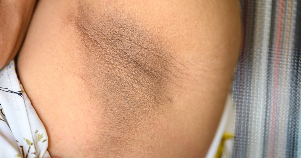 5 tips to treat dark underarms - Loop News