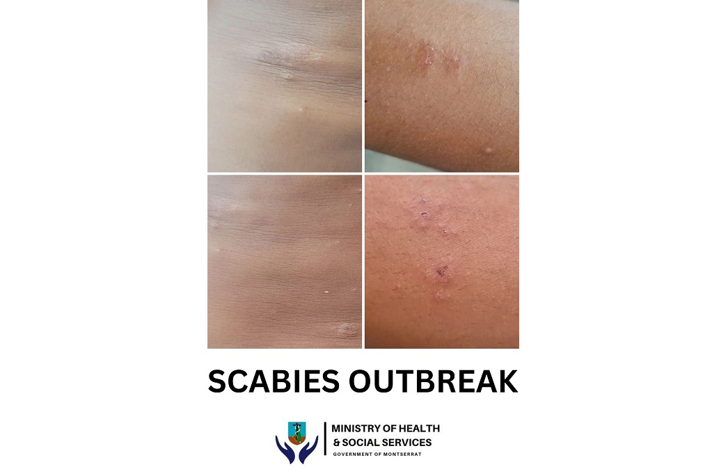 Scabies outbreak on Montserrat - Loop News